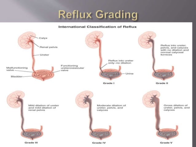 MCU- Micturating cysto-urethrogram | PPTX