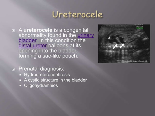 MCU- Micturating cysto-urethrogram | PPTX