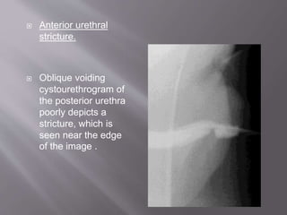 MCU- Micturating cysto-urethrogram | PPTX