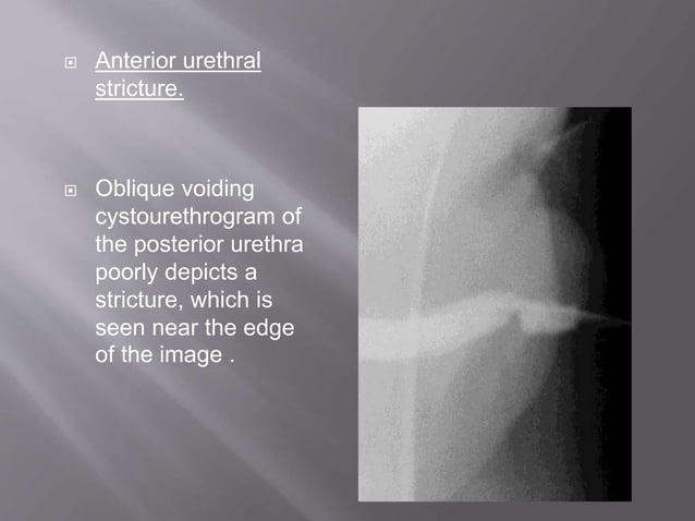 MCU- Micturating cysto-urethrogram | PPTX