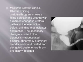 MCU- Micturating cysto-urethrogram | PPTX