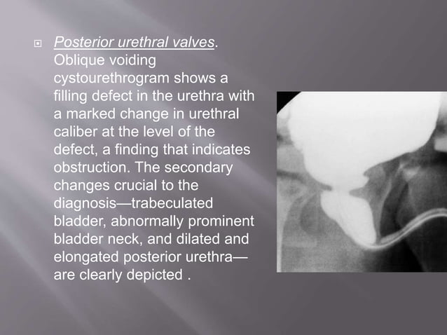 MCU- Micturating cysto-urethrogram | PPTX