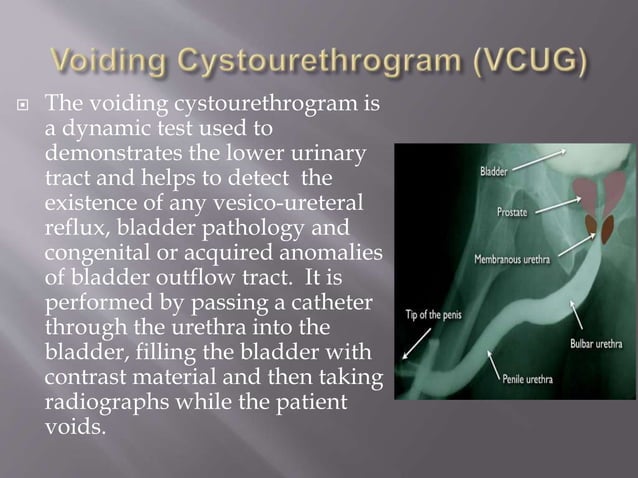 MCU- Micturating cysto-urethrogram | PPTX