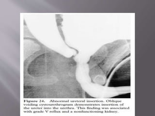MCU- Micturating cysto-urethrogram | PPTX