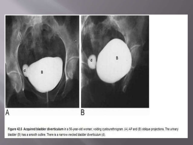 MCU- Micturating cysto-urethrogram | PPTX
