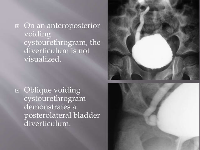 MCU- Micturating cysto-urethrogram | PPTX