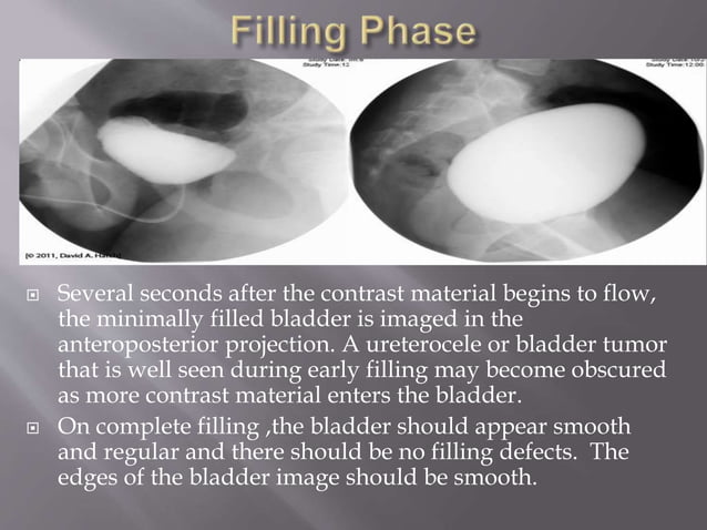 MCU- Micturating cysto-urethrogram | PPTX