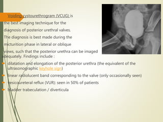 Vcug Procedure
