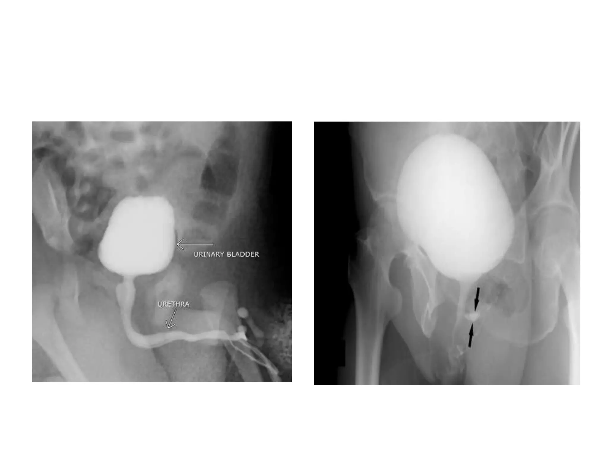 RGU MCU and its interpretation in pathology of Urinary Bladder ...