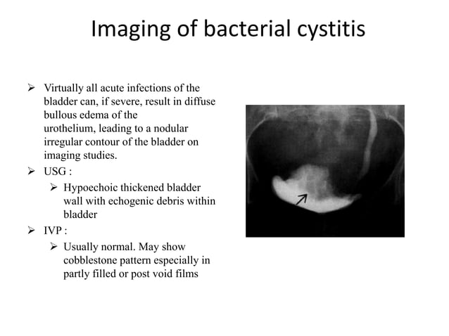 RGU MCU and its interpretation in pathology of Urinary Bladder ...