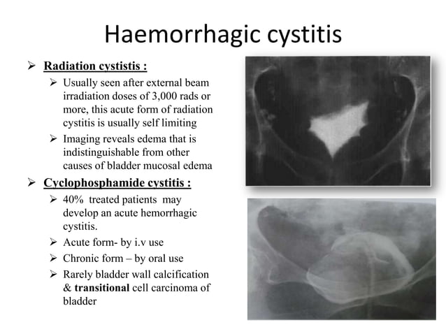 RGU MCU and its interpretation in pathology of Urinary Bladder ...