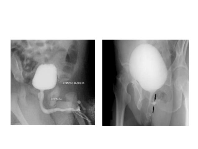 RGU MCU and its interpretation in pathology of Urinary Bladder & Uret…
