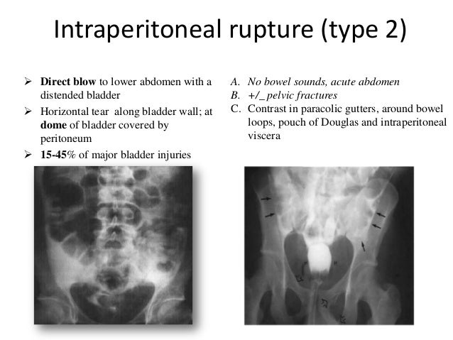 RGU MCU and its interpretation in pathology of Urinary Bladder & Uret…