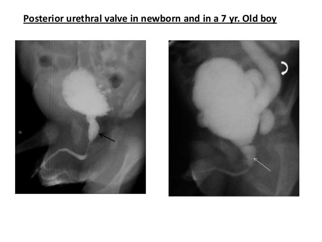 RGU MCU and its interpretation in pathology of Urinary Bladder & Uret…