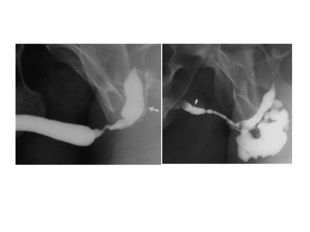 RGU MCU and its interpretation in pathology of Urinary Bladder & Uret…