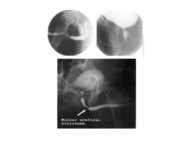 RGU MCU and its interpretation in pathology of Urinary Bladder & Uret…