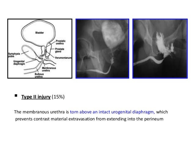 RGU MCU and its interpretation in pathology of Urinary Bladder & Uret…