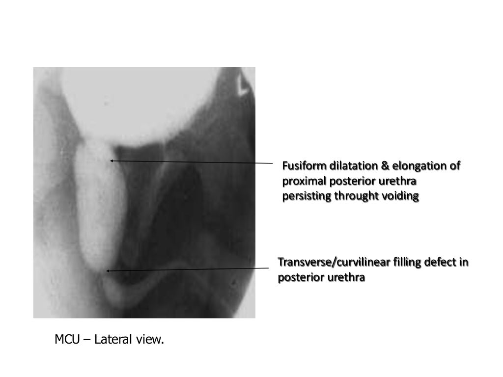 RGU MCU and its interpretation in pathology of Urinary Bladder & Uret…