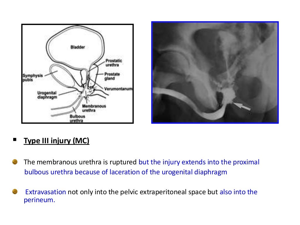 RGU MCU and its interpretation in pathology of Urinary Bladder & Uret…