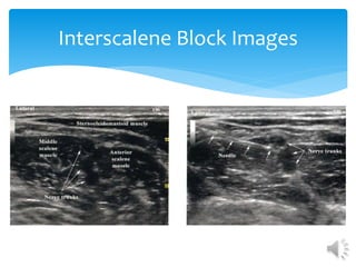 Fundamentals of Ultrasound Guided Peripheral Regional Anesthesia ...