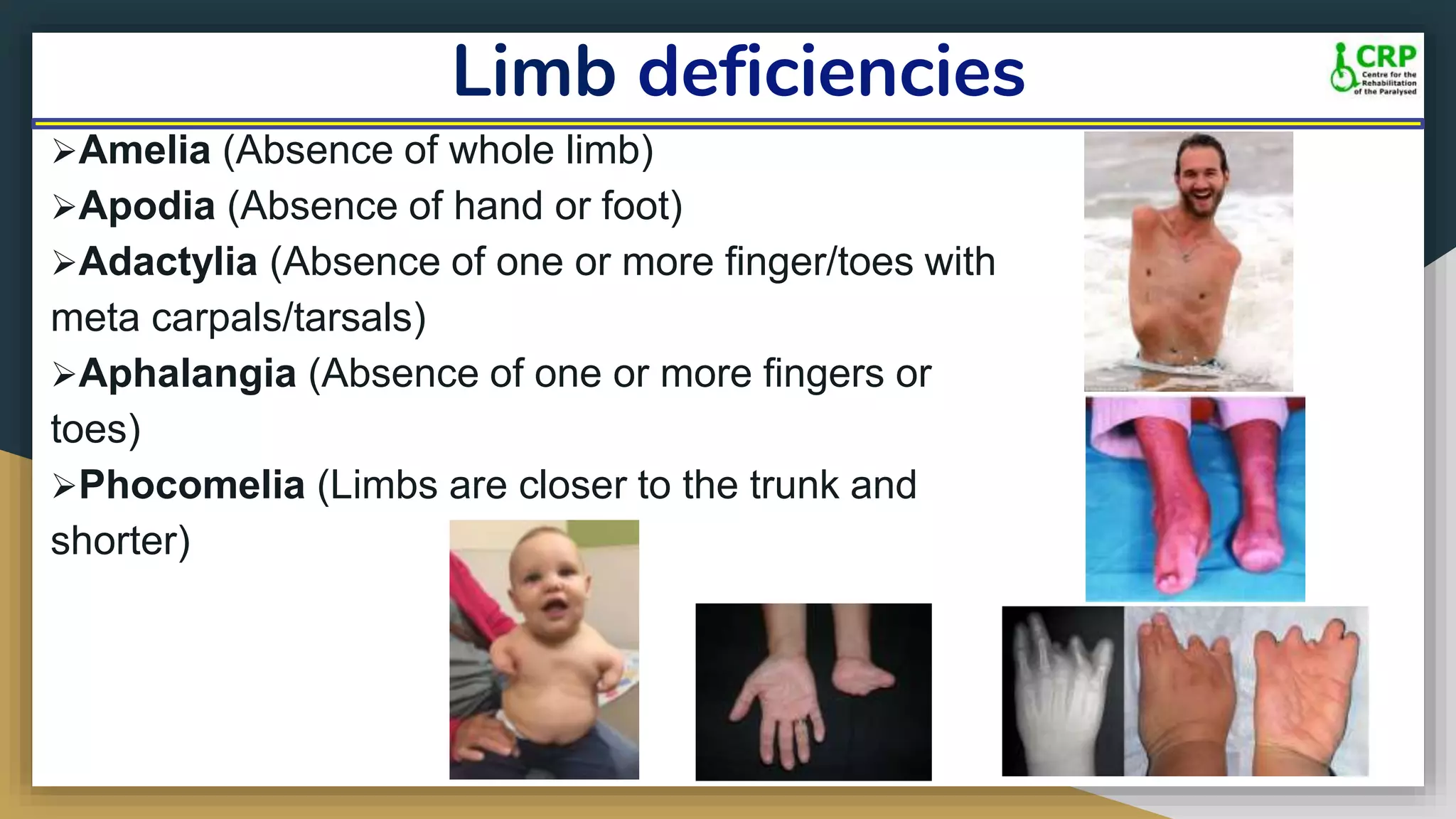 upper limb amputation | PPTX