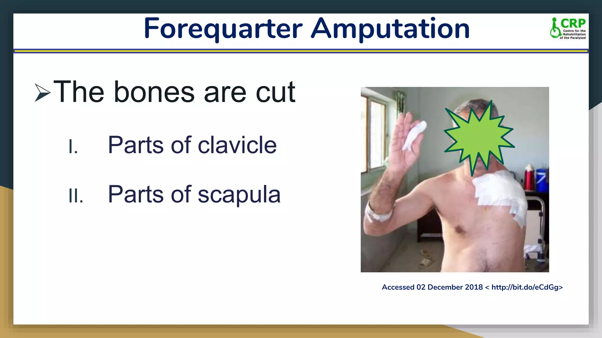 upper limb amputation | PPTX