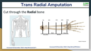 upper limb amputation | PPTX