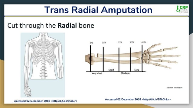 upper limb amputation | PPTX