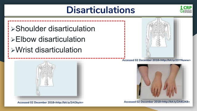 upper limb amputation | PPTX