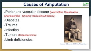 upper limb amputation | PPTX