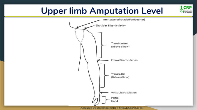 Upper Limb Amputation Pptx