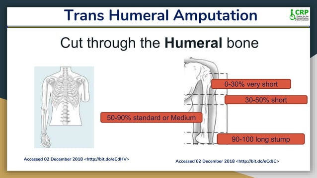 upper limb amputation | PPTX