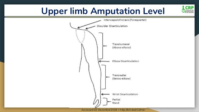 upper limb amputation