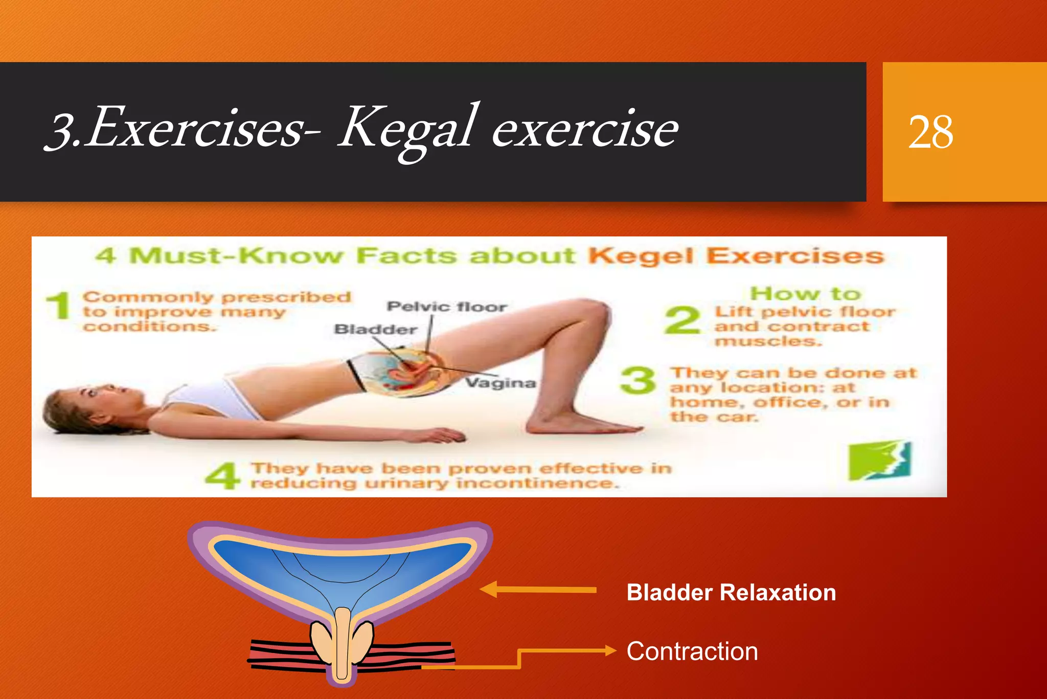 Stress Urinary Incontinence | PPTX