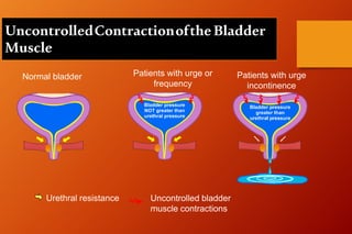 Stress Urinary Incontinence | PPTX