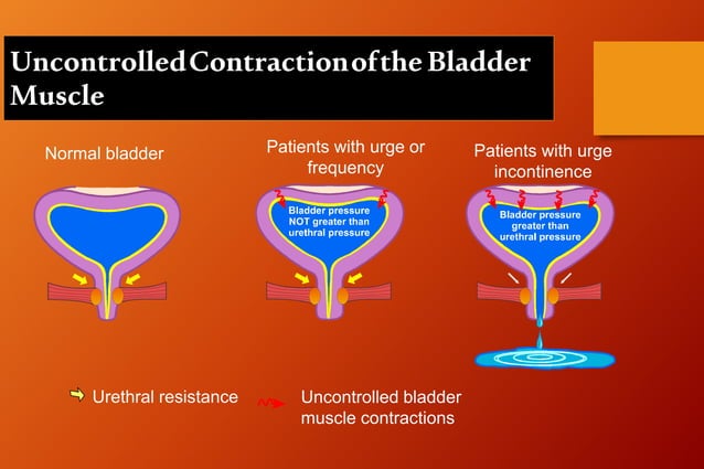 Stress Urinary Incontinence | PPTX | Sexual Conditions | Sexual Health