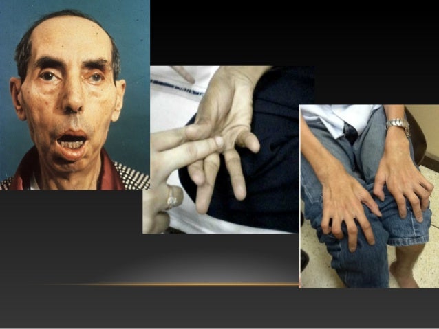 Patient of Myotonic Dystrophy presented with Celebellar Infarction