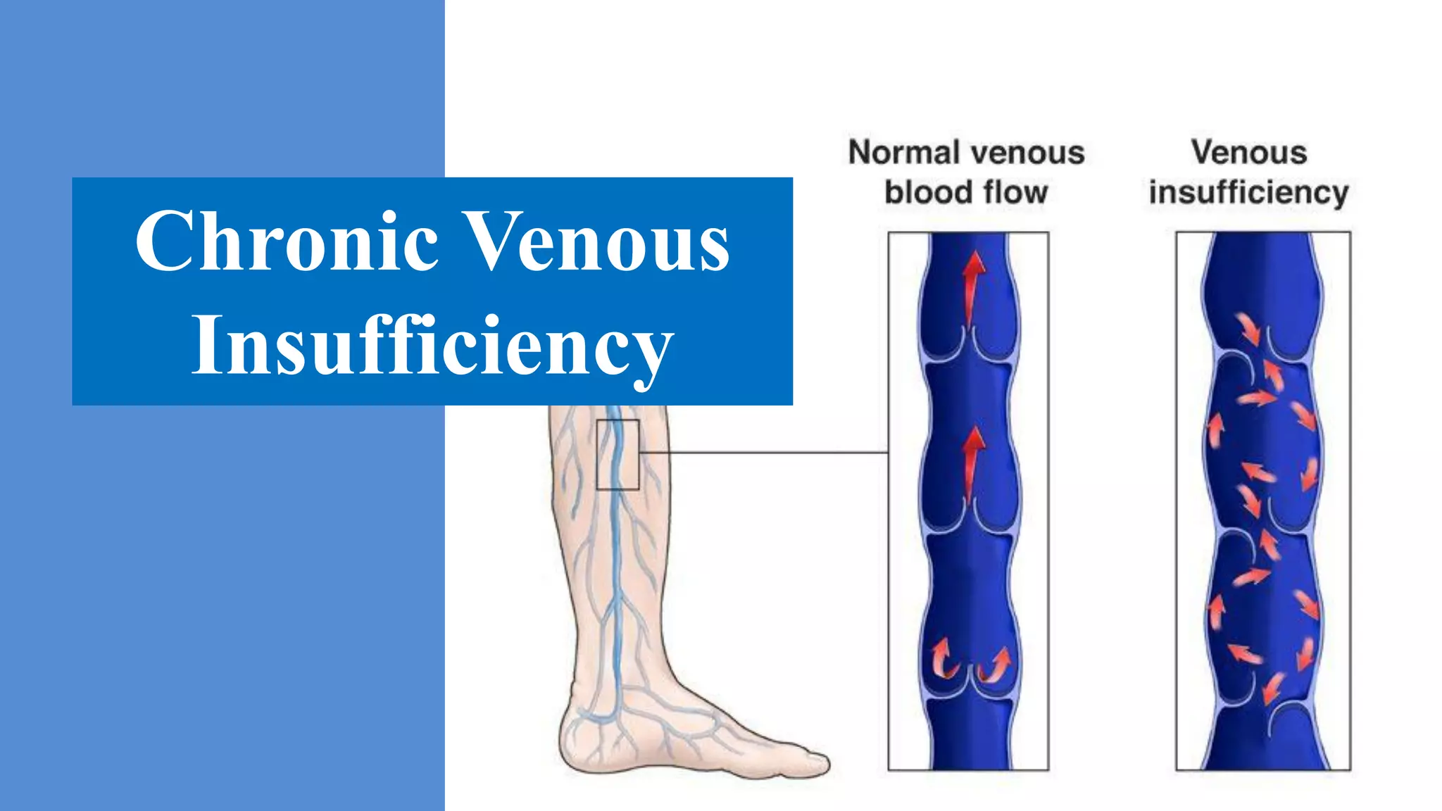 MD61 Group2 - Chronic Venous Insufficiency (Presentation).pdf