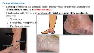 MD61 Group2 - Chronic Venous Insufficiency (Presentation).pdf