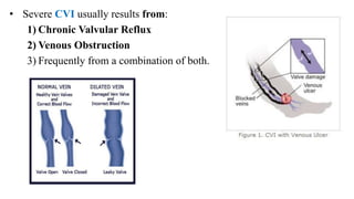 MD61 Group2 - Chronic Venous Insufficiency (Presentation).pdf