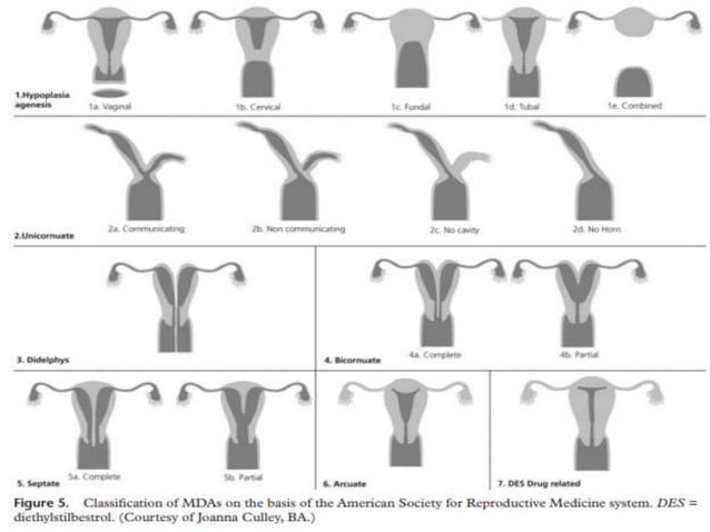 Mullerian Duct Anomalies | PPTX