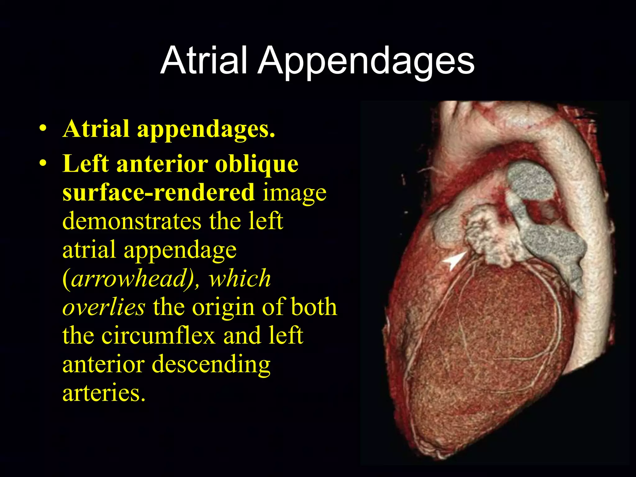 MDCT Anatomy of Heart Dr. Muhammad Bin Zulfiqar | PPTX