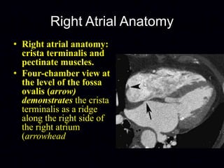 MDCT Anatomy of Heart Dr. Muhammad Bin Zulfiqar | PPTX