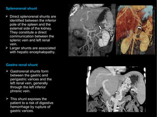 MDCT Evaluation of Varices in Portal Hypertension | PPT