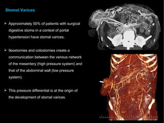 MDCT Evaluation of Varices in Portal Hypertension | PPT