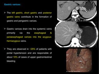 Gastric Varices Ct
