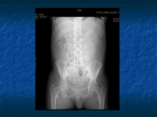 NON-CONTRAST ENHANCED MULTIDETECTOR COMPUTED TOMOGRAPHY VERSUS PLAIN X ...