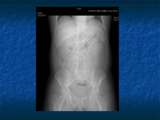 NON-CONTRAST ENHANCED MULTIDETECTOR COMPUTED TOMOGRAPHY VERSUS PLAIN X ...