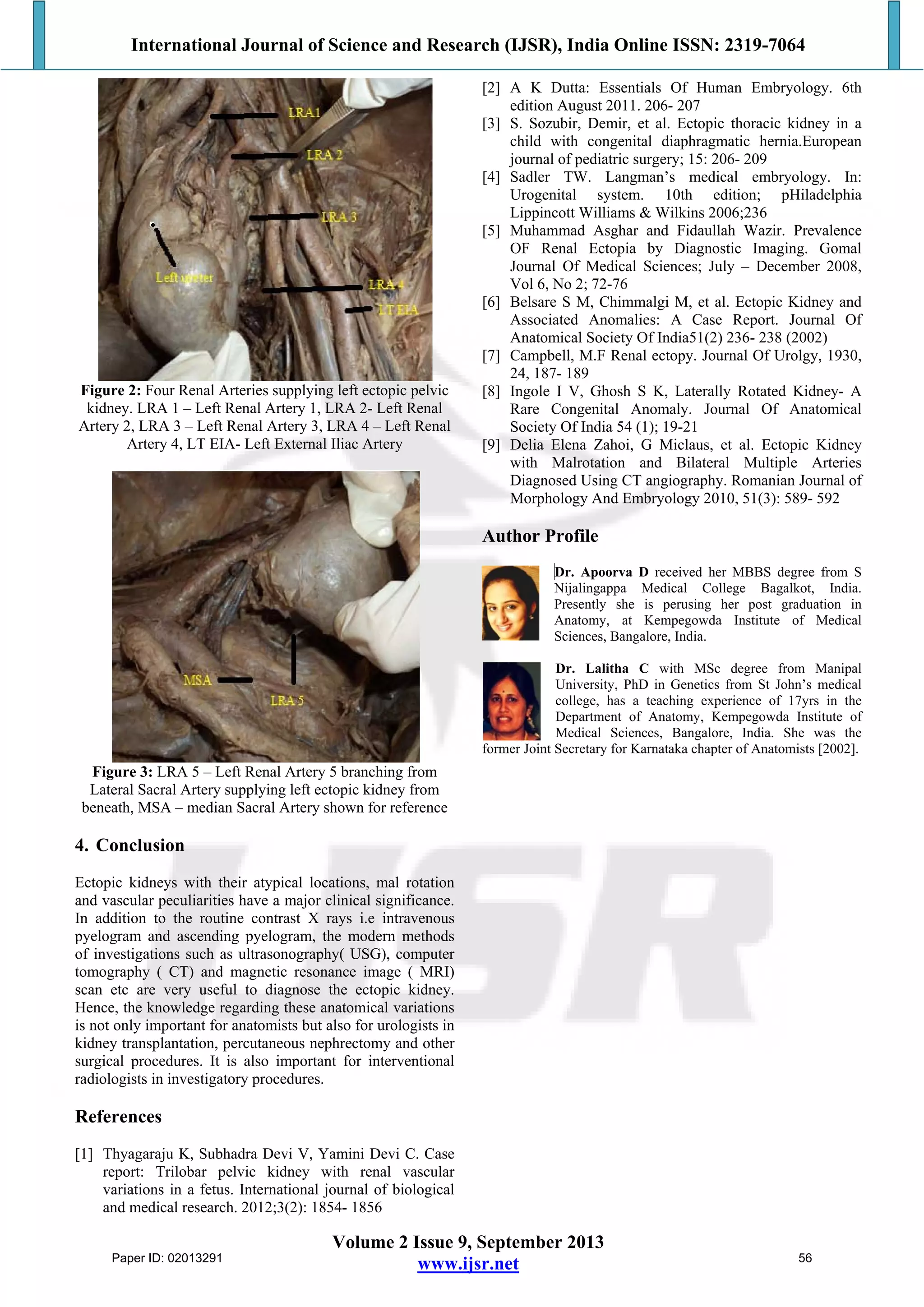 Unascended Left Kidney with Malrotation: A Rare Congenital Anomaly | PDF
