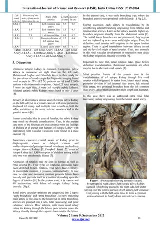 Unascended Left Kidney with Malrotation: A Rare Congenital Anomaly | PDF